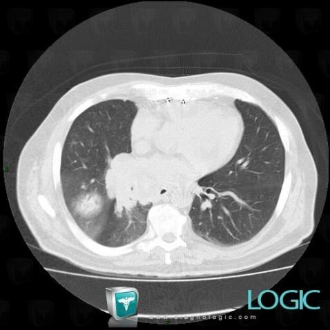 Cas radiologie : Cancer bronchique à petites cellules (Scanner ...