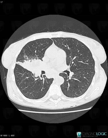 Cas radiologie : Cancer bronchique à petites cellules (Scanner ,Radio ...