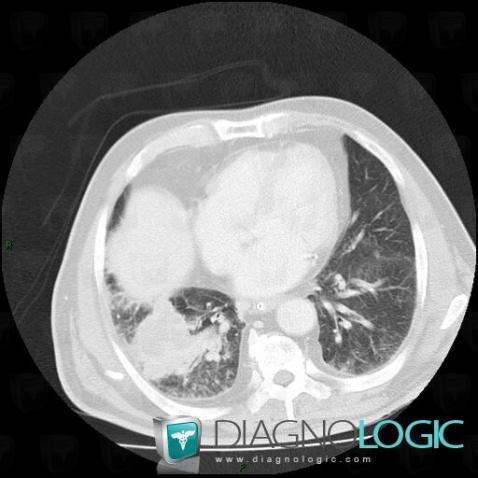 Cas radiologie : Métastase (Scanner ,IRM) - Diagnologic