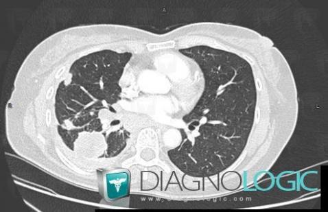 Cas radiologie : Carcinose pleurale (Scanner) - Diagnologic