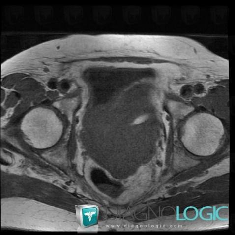 Cas radiologie : Métastase (IRM) - Diagnologic