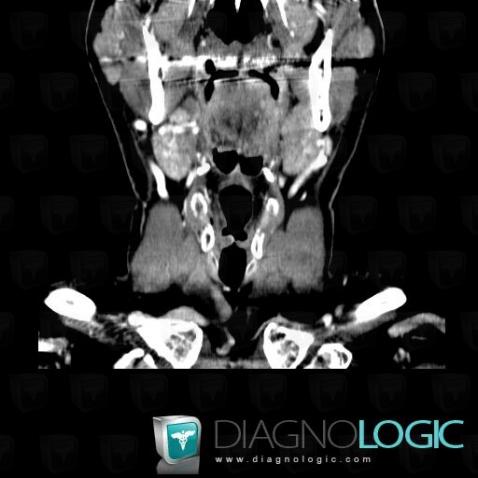 Cas radiologie : Cancer glottique (Scanner) - Diagnologic