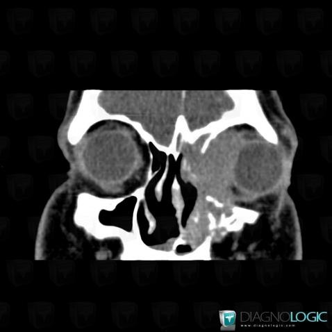 Cas radiologie : Carcinome épidermoïde (Scanner ,IRM) - Diagnologic