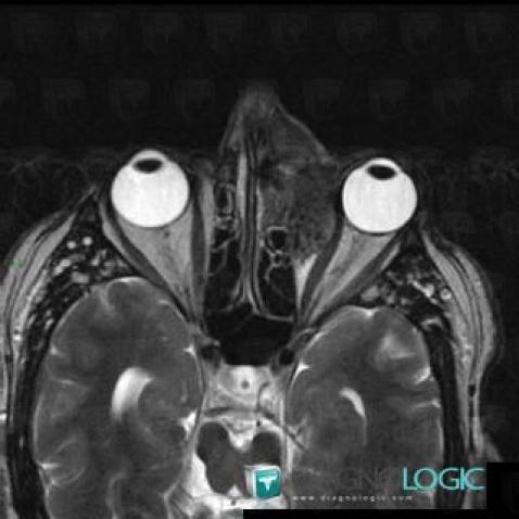Cas radiologie : Carcinome épidermoïde (Scanner ,IRM) - Diagnologic