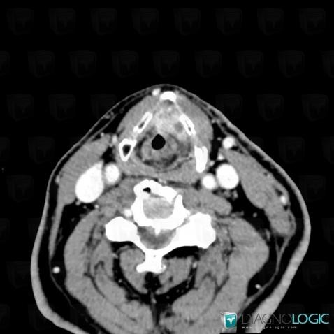 Cas radiologie : Cancer supraglottique (Scanner) - Diagnologic
