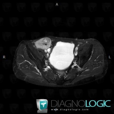 Cas radiologie : Carcinome rénal à cellules papillaires (IRM) - Diagnologic