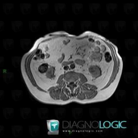 Cas radiologie : Carcinome rénal à cellules papillaires (IRM) - Diagnologic