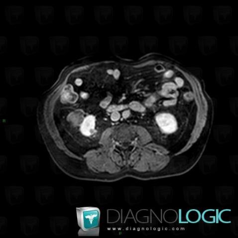 Cas radiologie : Carcinome rénal à cellules papillaires (IRM) - Diagnologic