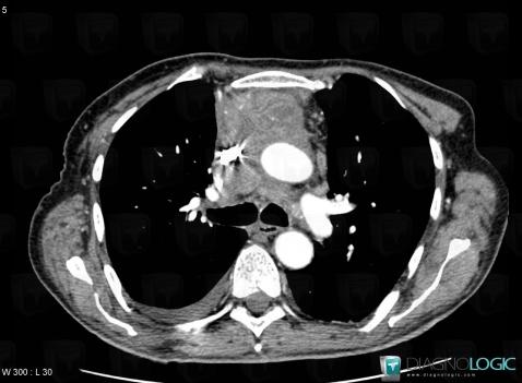 Cas radiologie : Carcinome thymique (Scanner) - Diagnologic
