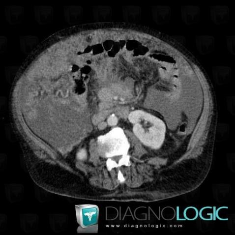 Cas radiologie : Métastase (Scanner) - Diagnologic