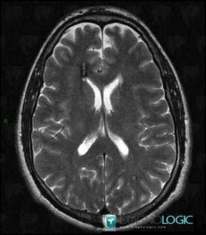 Radiology case : Cavernous angioma (CT ,MRI) - Diagnologic