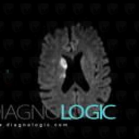 Radiology case : Cerebral infarction (MRI) - Diagnologic
