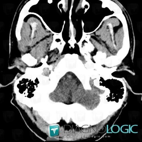 Radiology case : Cerebral infarction (CT ,MRI) - Diagnologic