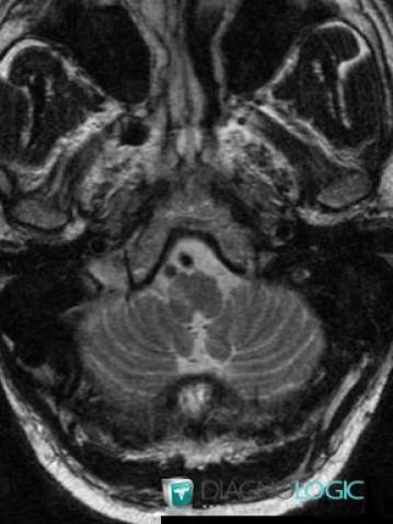 Radiology case : Cerebral infarction (CT ,MRI) - Diagnologic