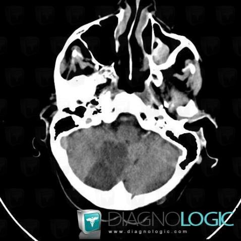 Radiology case : Cerebral infarction (CT) - Diagnologic