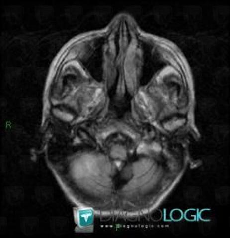 Radiology case : Cerebral infarction (MRI) - Diagnologic