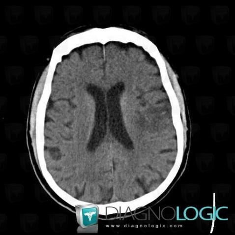 Radiology case : Cerebral infarction (CT) - Diagnologic