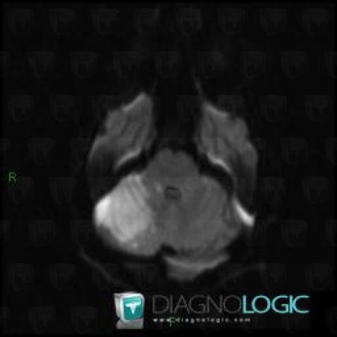 Radiology case : Cerebral infarction (MRI) - Diagnologic