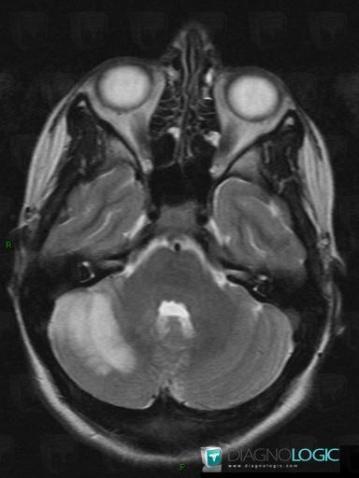 Radiology case : Cerebral infarction (MRI) - Diagnologic