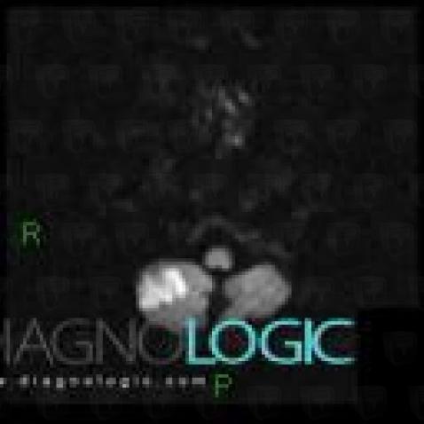 Radiology case : Cerebral infarction (MRI) - Diagnologic