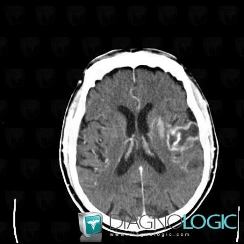 Radiology case : Cerebral infarction (CT) - Diagnologic