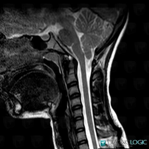 Radiology case : Chiari I malformation (MRI) - Diagnologic