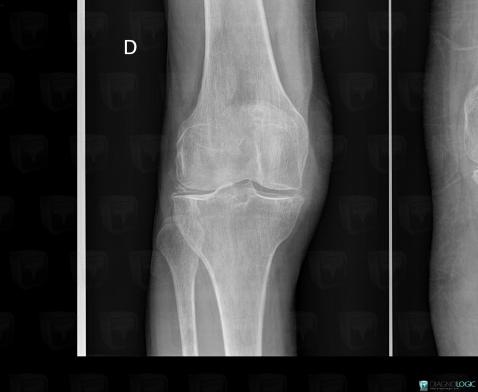 Cas radiologie : Chondrocalcinose articulaire (Radio) - Diagnologic