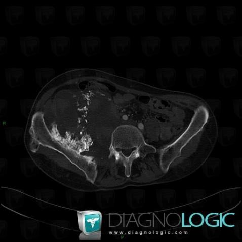 Cas radiologie : Chondrosarcome (Scanner ,IRM) - Diagnologic
