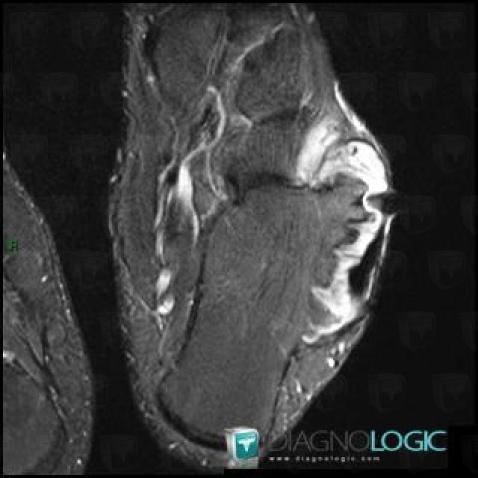 Cas radiologie : Chondrosarcome (Scanner ,IRM) - Diagnologic