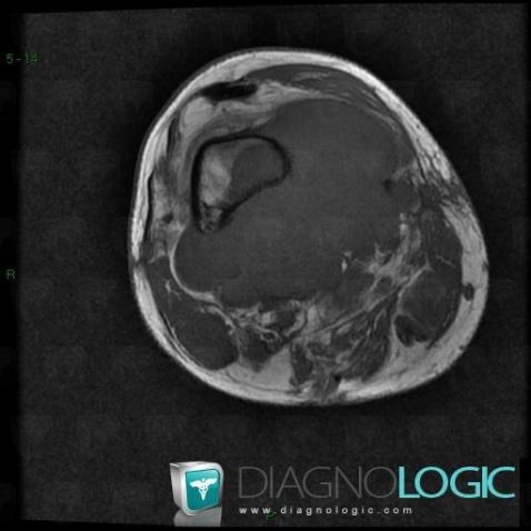 Cas radiologie : Chondrosarcome (IRM ,Radio) - Diagnologic