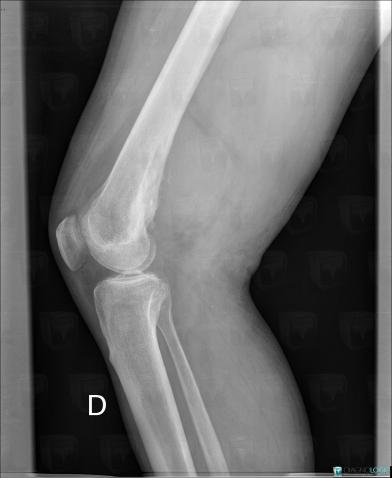 Cas radiologie : Chondrosarcome (IRM ,Radio) - Diagnologic