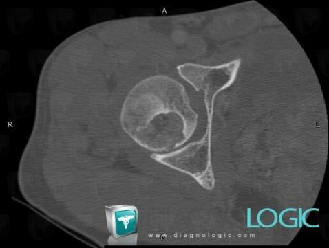 Cas radiologie : Chondrosarcome (Scanner ,IRM) - Diagnologic