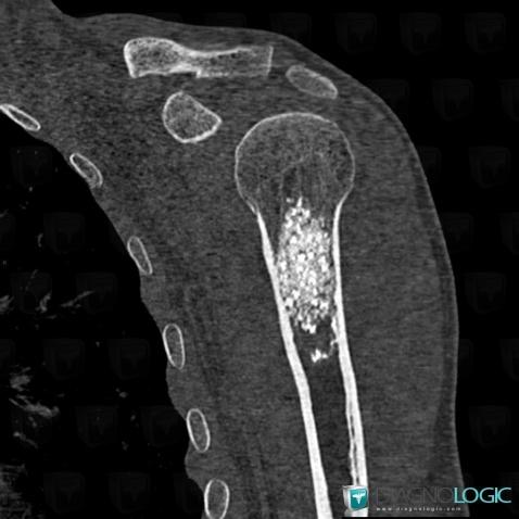 Cas radiologie : Chondrosarcome (Scanner ,Radio) - Diagnologic