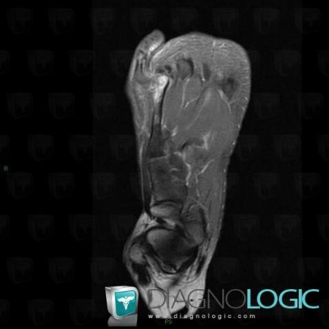 Cas radiologie : Chondrosarcome (IRM ,Radio) - Diagnologic