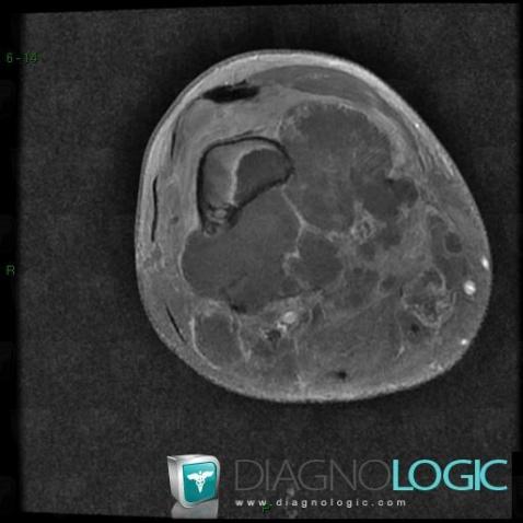Cas radiologie : Chondrosarcome (IRM ,Radio) - Diagnologic