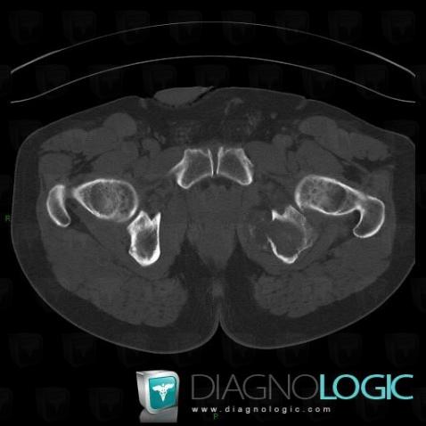 Cas radiologie : Chondrosarcome (Scanner ,Radio ,IRM) - Diagnologic
