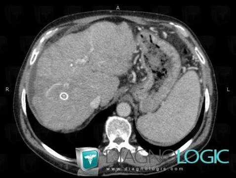 Radiology case : Cirrhosis (CT ,US) - Diagnologic
