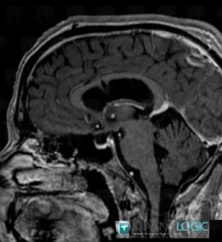 Radiology case : Colloid cyst (CT ,MRI) - Diagnologic