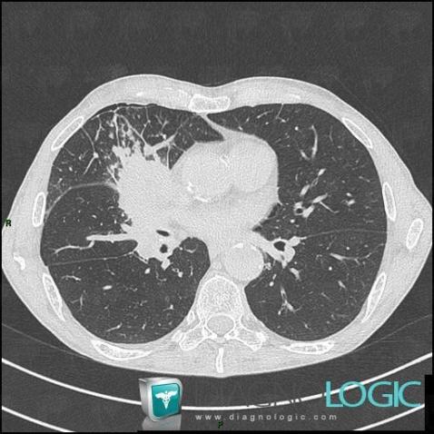 Cas radiologie : Emphysème centrolobulaire (Scanner) - Diagnologic
