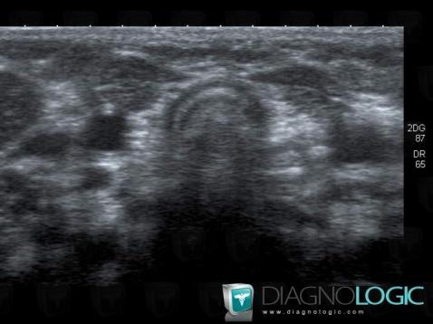 Radiology case : Congenital athyreosis (US) - Diagnologic
