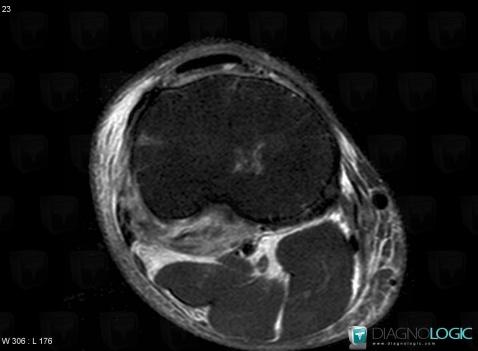 Radiology case : Contusion (MRI) - Diagnologic