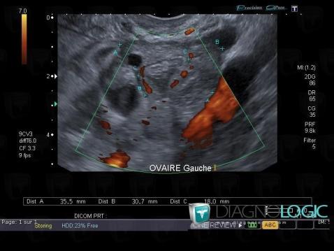 Radiology case : Corpus luteum (US) - Diagnologic