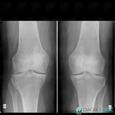 Radiology case : CPPD (X rays ,US) - Diagnologic