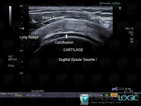 Radiology case : CPPD (X rays ,US) - Diagnologic