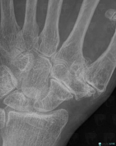 Radiology case : Degenerative joint disease (X rays) - Diagnologic