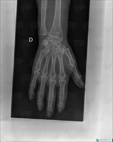 Radiology case : CPPD (X rays) - Diagnologic