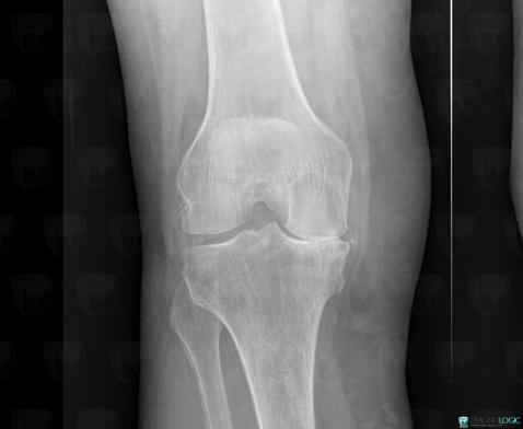 Radiology case : CPPD (X rays) - Diagnologic