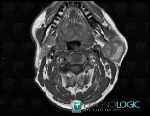 Cas radiologie : Cystadénolymphome (IRM) - Diagnologic