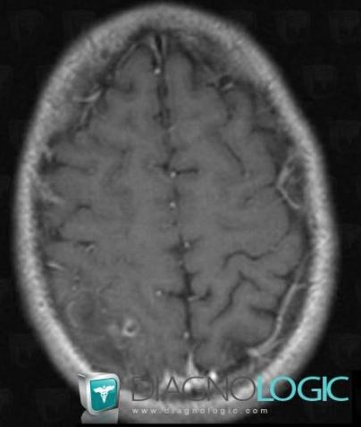 Cas radiologie : Cysticercose (Scanner ,IRM) - Diagnologic