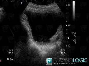 Thickening Of Bladder Wall International Neurourology Journal